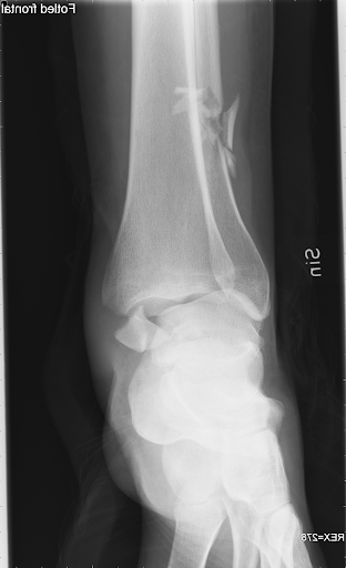 Annotated radiographs of ankle fractures for research | doi:10.23698 ...