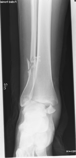 Annotated radiographs of ankle fractures for research | doi:10.23698 ...