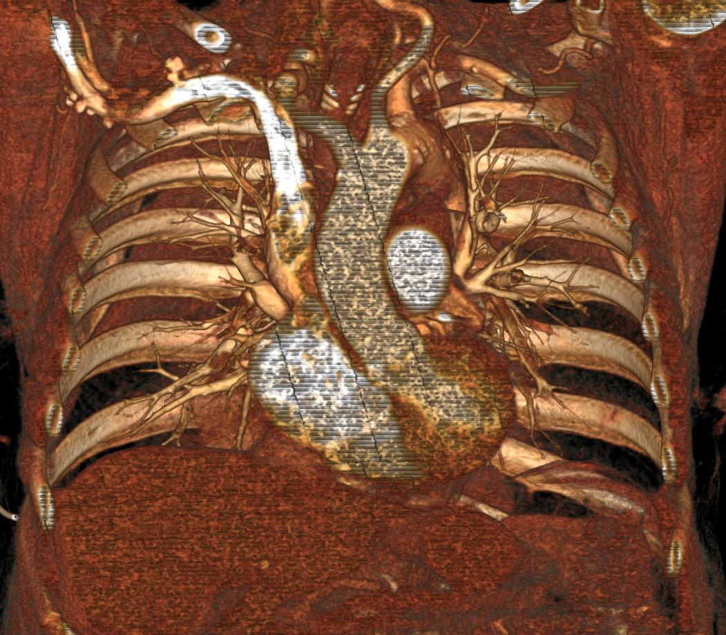 Computed Tomography Pulmonary Angiography (CTPA) data | doi:10.23698 ...