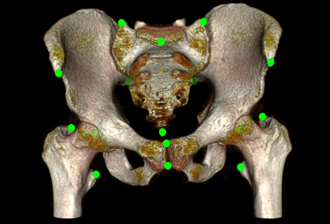Segmented CT pelvis scans with annotated anatomical landmarks | doi:10. ...