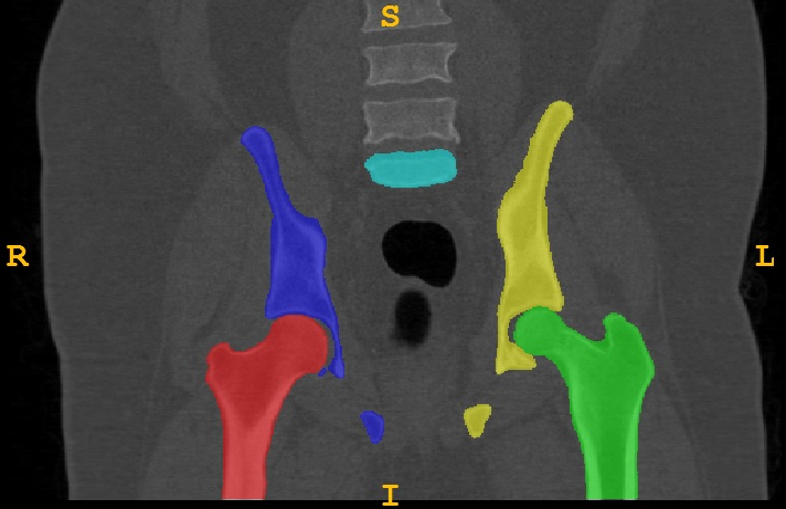 Segmented Ct Pelvis Scans With Annotated Anatomical Landmarks Doi 10