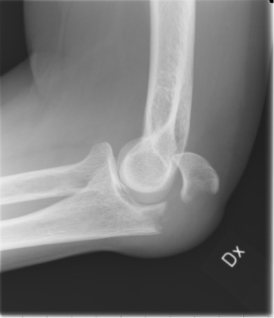 Elbow radiographs with classified fractures according to 2018 AO/OTA ...