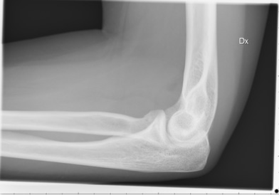 Elbow radiographs with classified fractures according to 2018 AO/OTA ...
