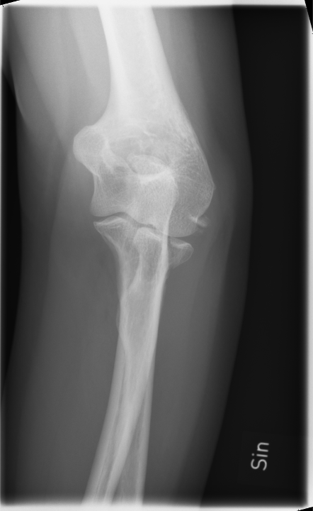 Elbow radiographs with classified fractures according to 2018 AO/OTA ...