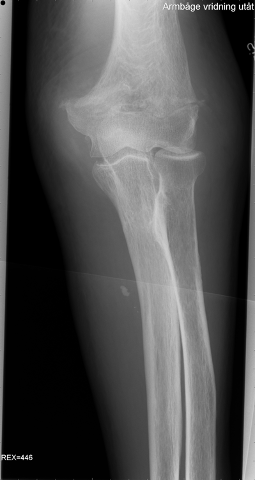 Elbow radiographs with classified fractures according to 2018 AO/OTA ...