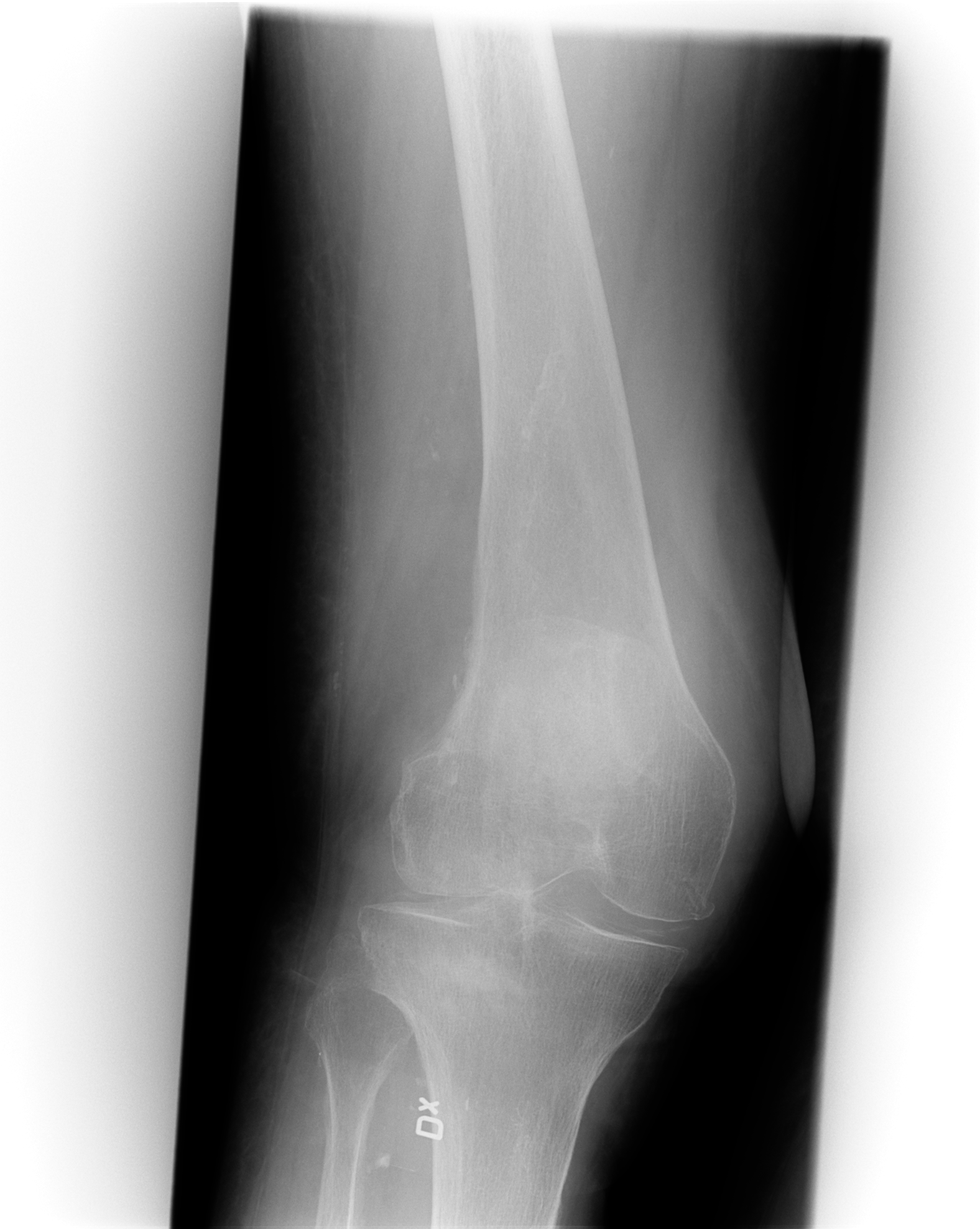 Knee fracture classification according to AO/OTA 2018 | doi:10.23698 ...