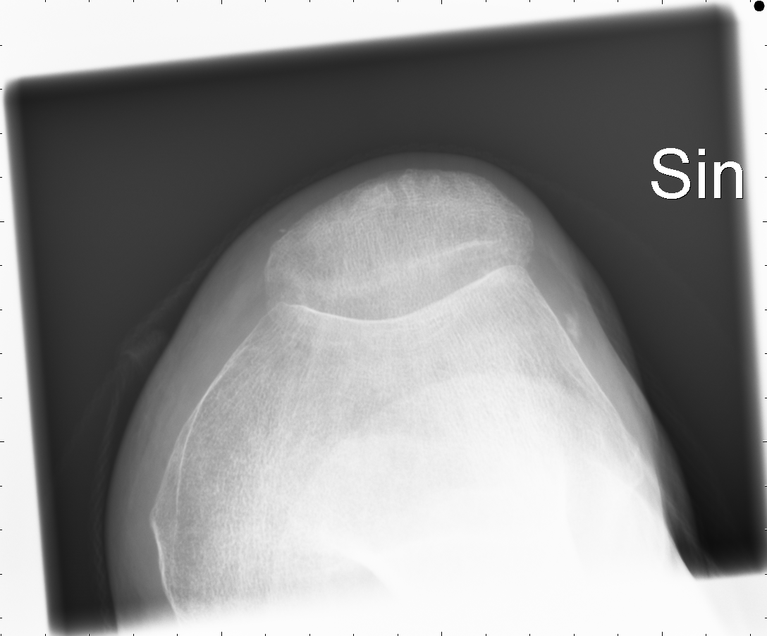 Knee fracture classification according to AO/OTA 2018 | doi:10.23698 ...