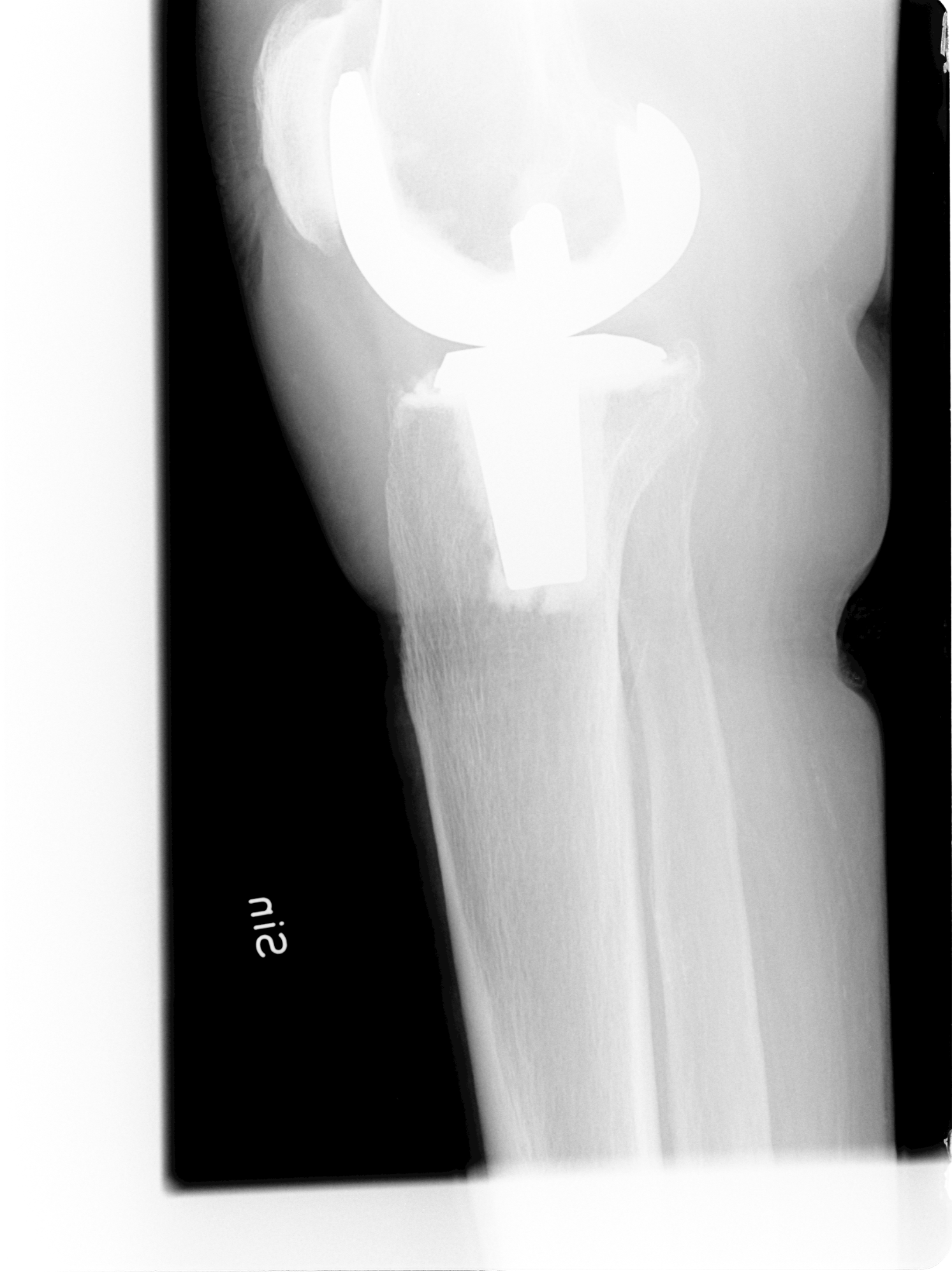 Knee fracture classification according to AO/OTA 2018 | doi:10.23698 ...