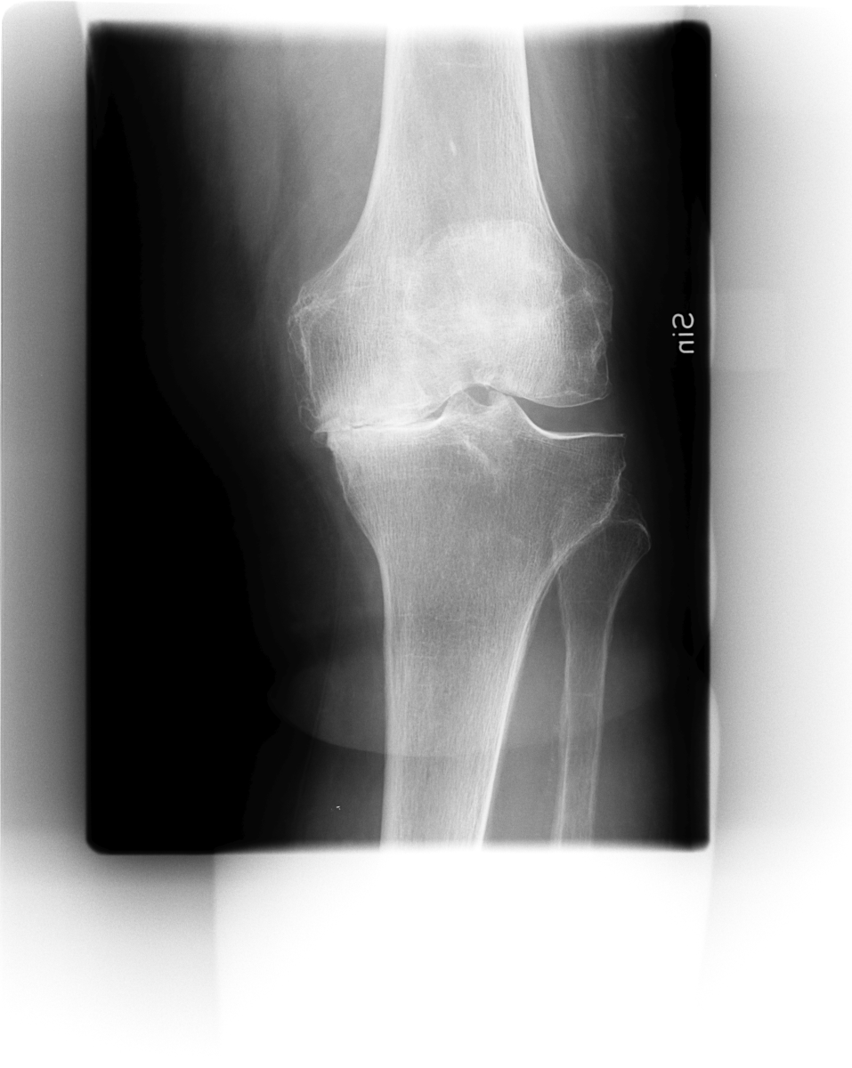 Knee osteoarthritis classification according to Kellgren-Lawrence | doi ...