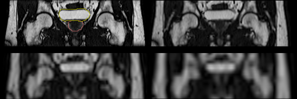Low-resolution prostate MR | doi:10.23698/aida/lesser | AIDA dataset ...