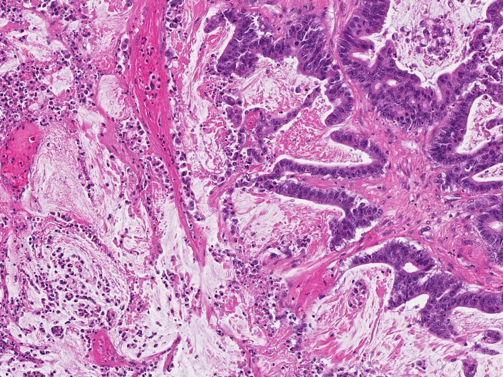 Regional lymph node metastasis in colon adenocarcinoma, second ...