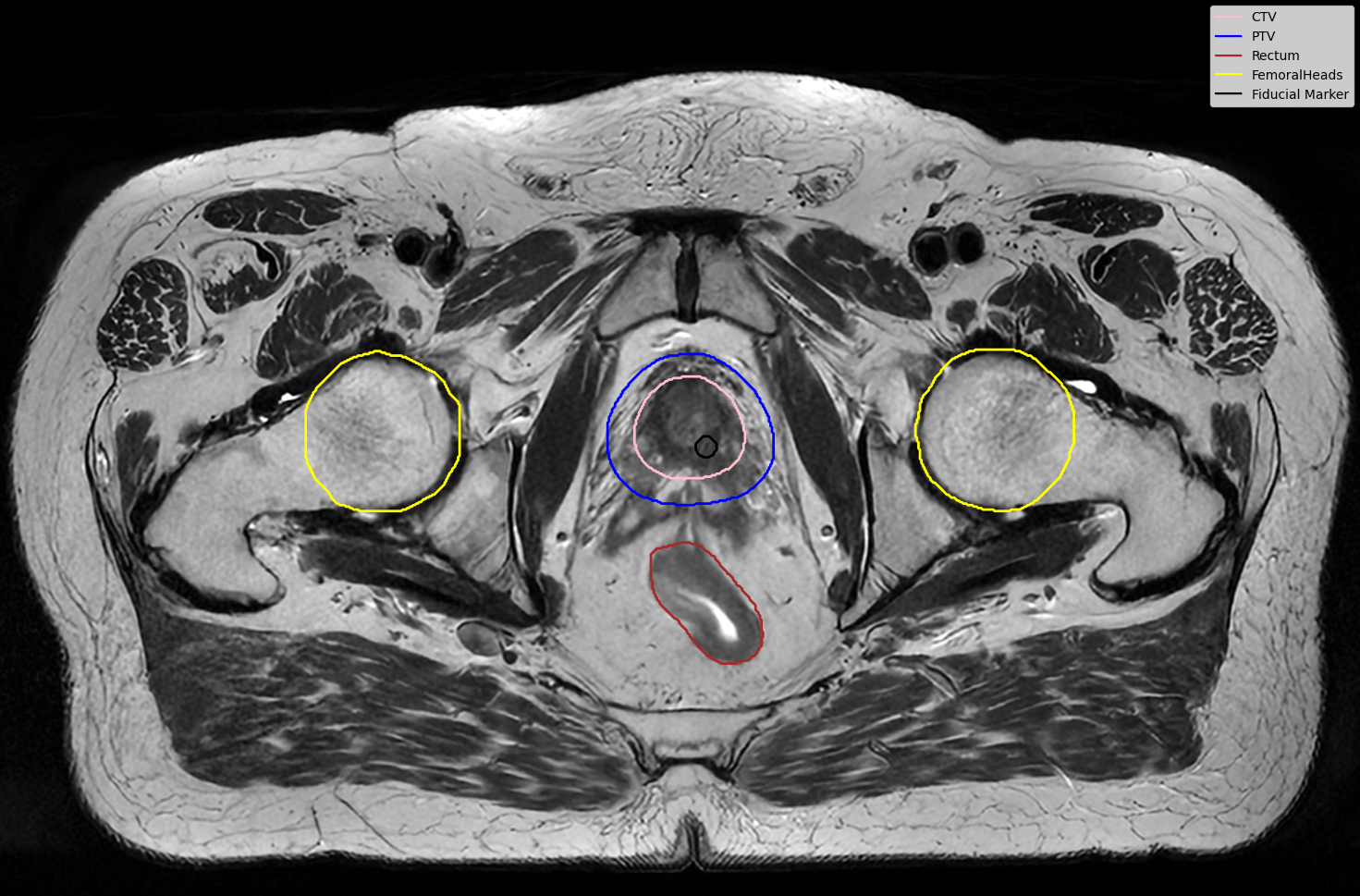 LUND-PROBE - LUND Prostate Radiotherapy Open Benchmarking and Evaluation dataset | doi:10.23698 ...