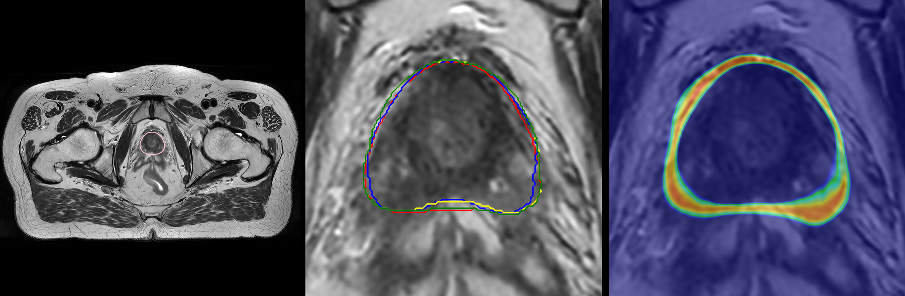 LUND-PROBE - LUND Prostate Radiotherapy Open Benchmarking and Evaluation dataset | doi:10.23698 ...