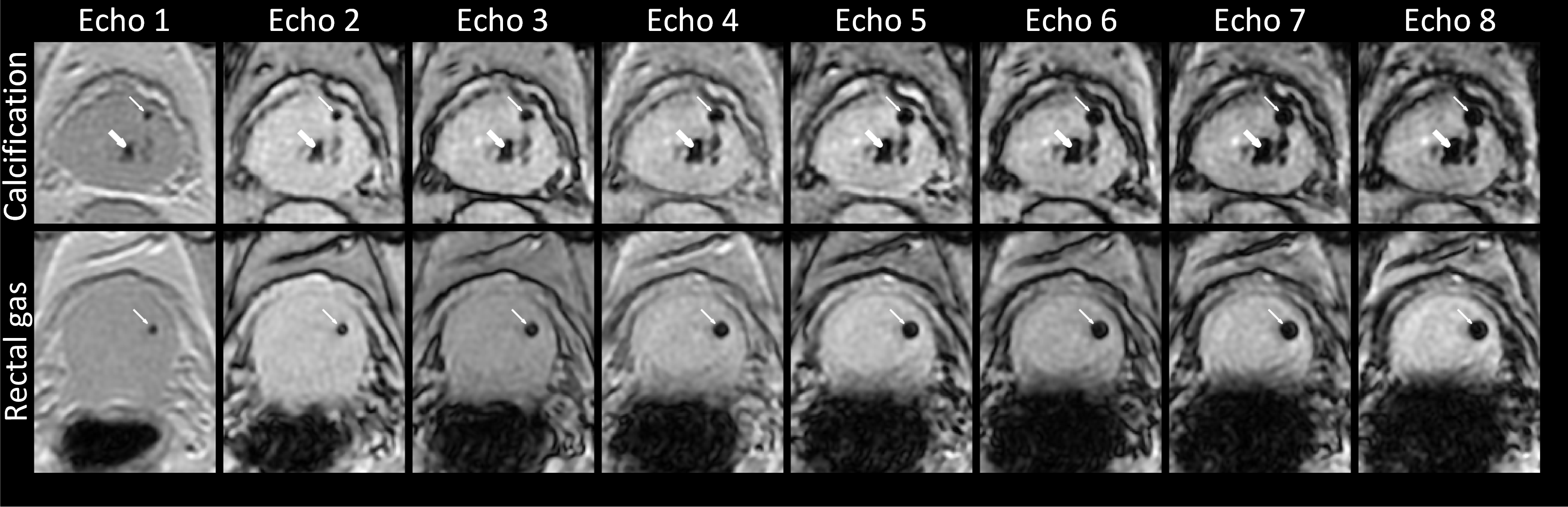 Multi-echo gradient echo (MEGRE) | doi:10.23698/aida/megre | AIDA ...