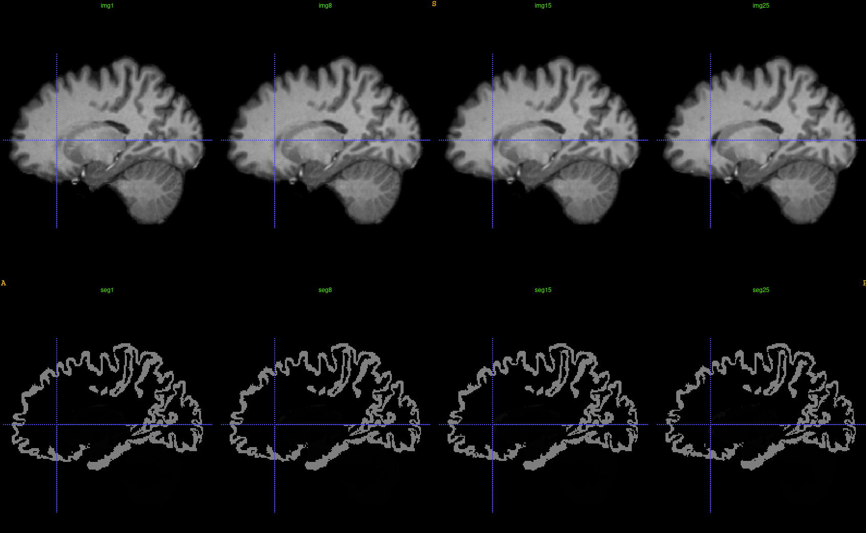 Synthetic healthy brain aging MRIs with segmentation masks | doi:10. ...