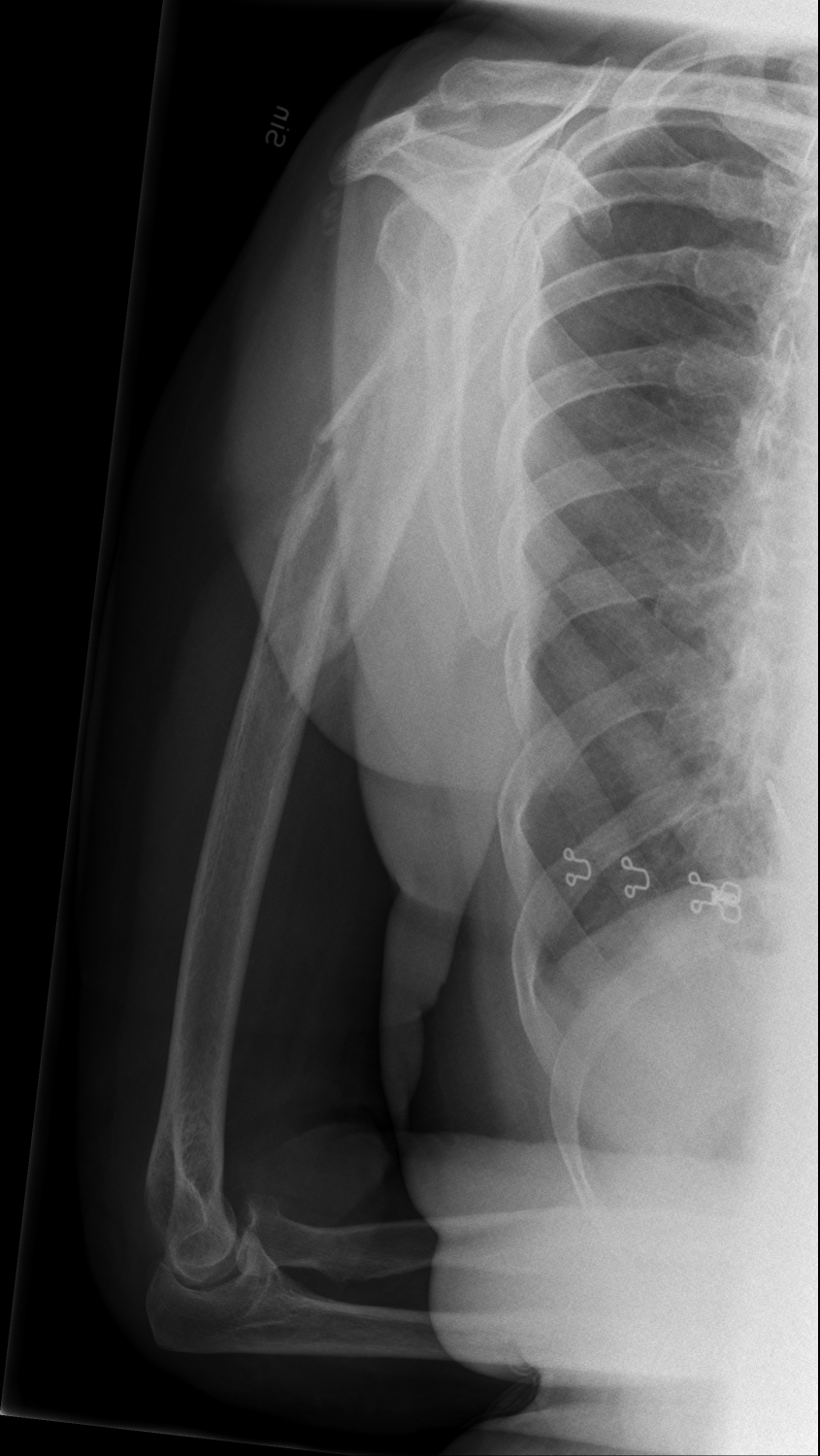 Shoulder radiographs classified on both fractures according to 2018 AO ...