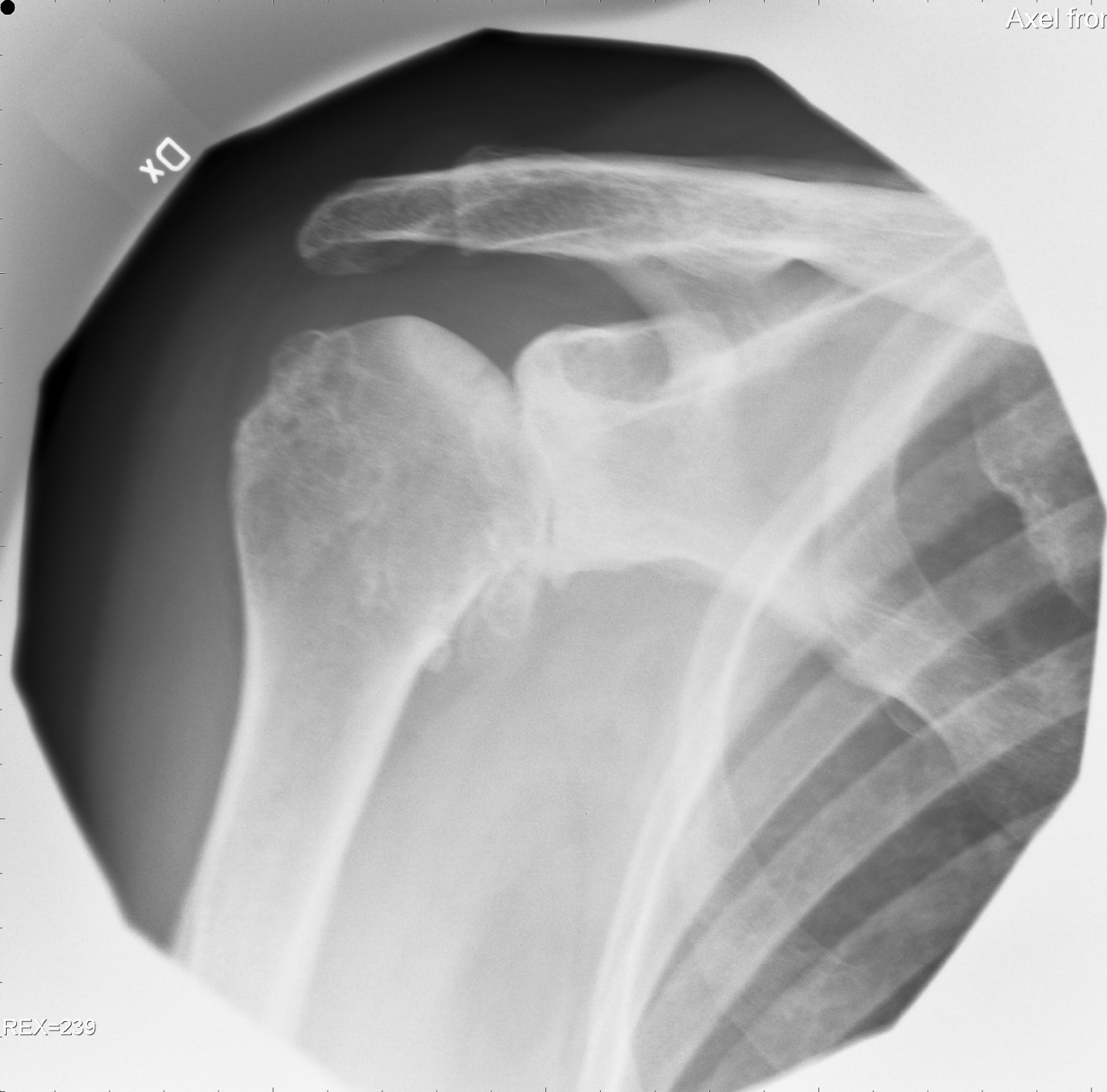 Shoulder radiographs classified on both fractures according to 2018 AO ...