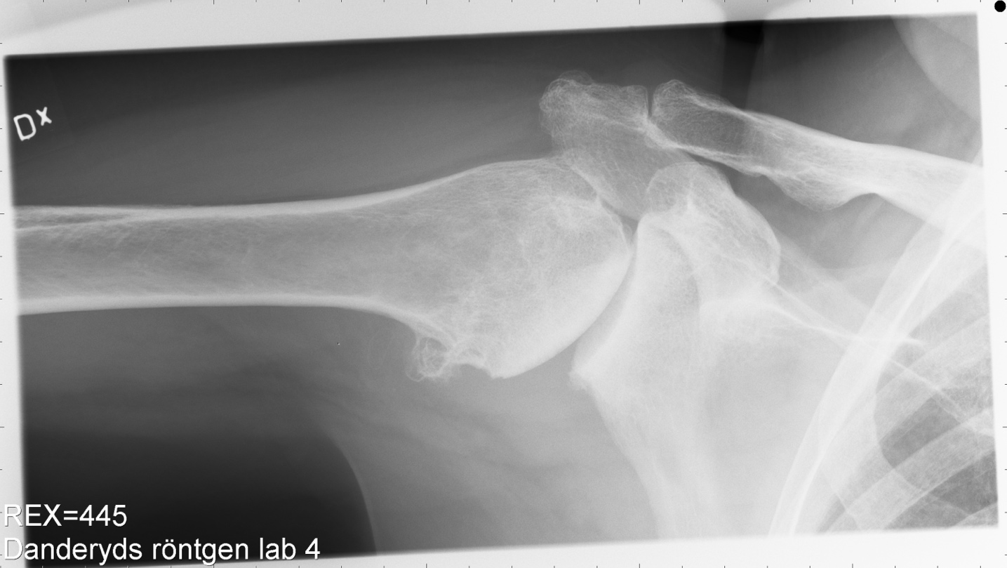 Shoulder radiographs classified on both fractures according to 2018 AO ...